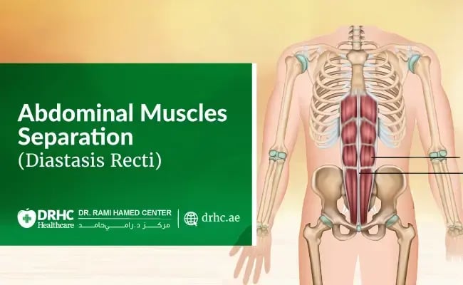 Abdominal Muscles Separation (Diastasis Recti)